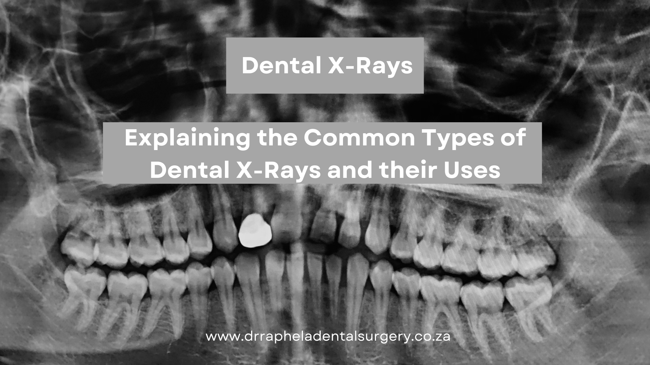 Explaining the Common Types of Dental X-Rays and their Uses
